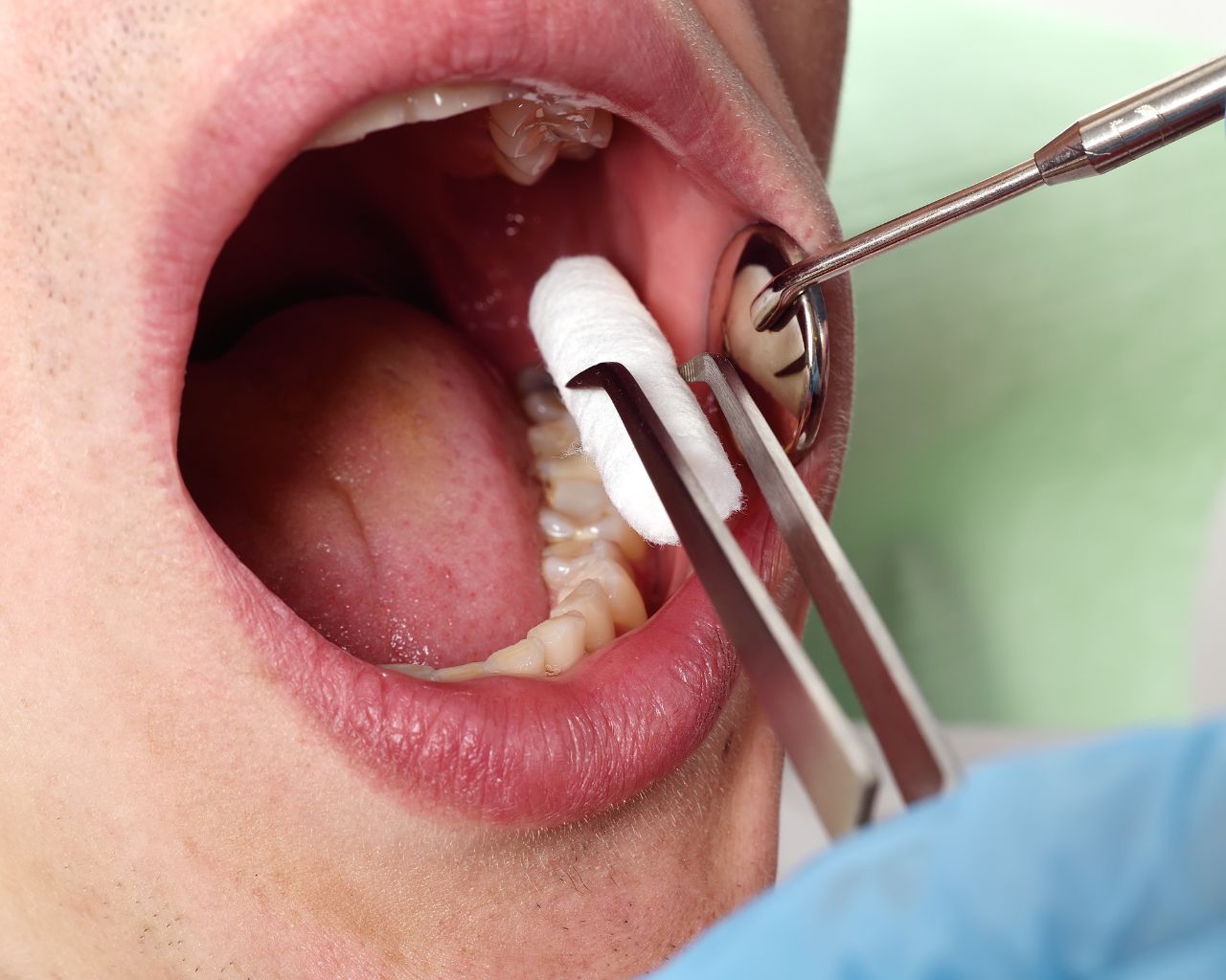 ¿Si una muela se mueve hay que extraerla? | Soludental